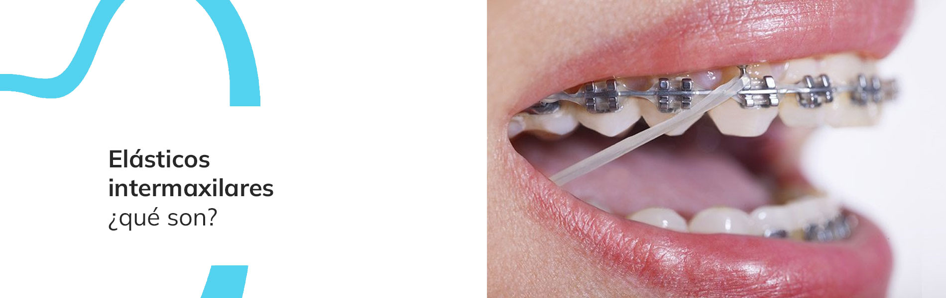¿Qué son los elásticos intermaxilares?